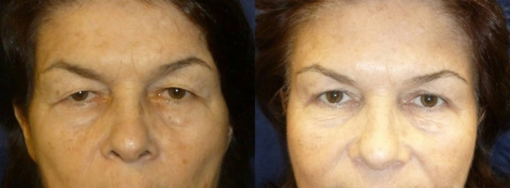 Blepharoplasty Before and after Photos | Avana Plastic Surgery