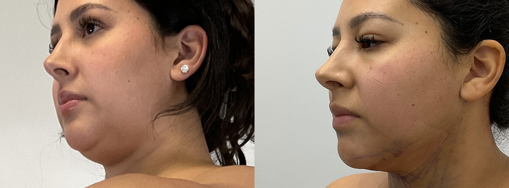 Chin Liposuction Before and after Photos | Avana Plastic Surgery