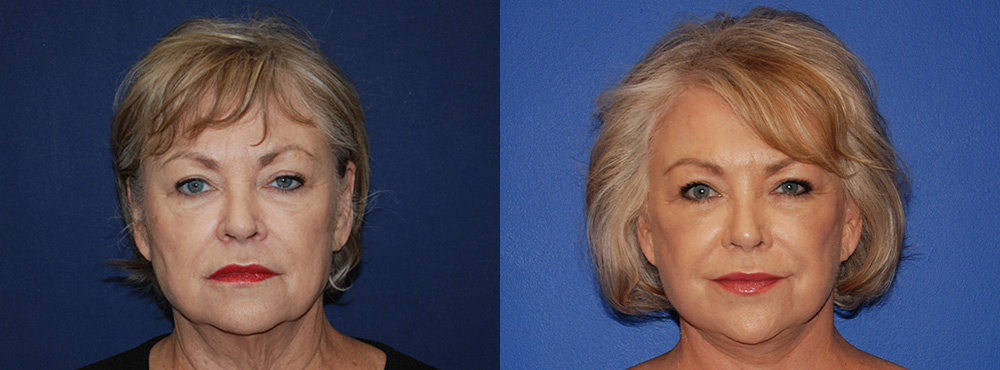 Face Lift Before and after Photos by Dr. Shane McDaniel | Avana Plastic Surgery