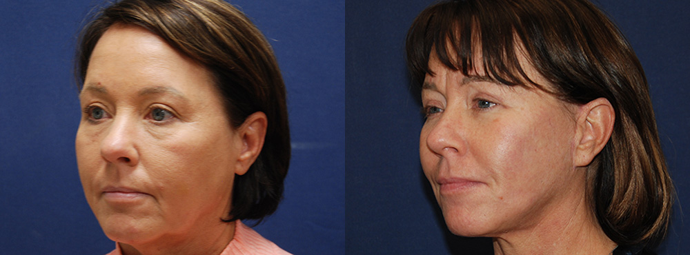 Face Lift Before and after Photos by Dr. Shane McDaniel | Avana Plastic Surgery